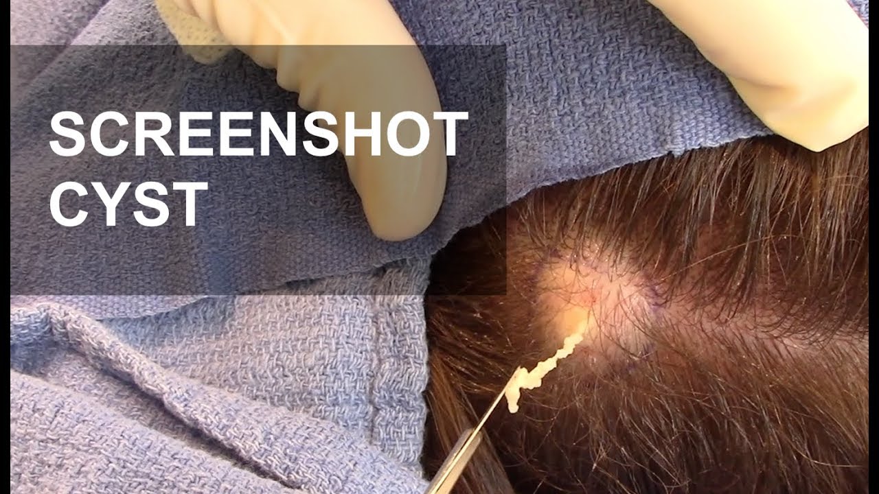 Screenshot Shooting Cyst | Dr. Derm - YouTube