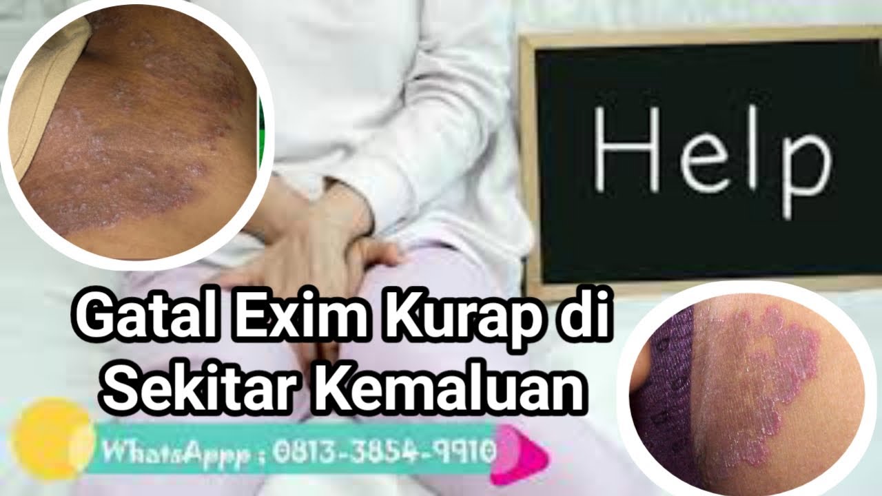 obat gatal exim selangkangan - YouTube