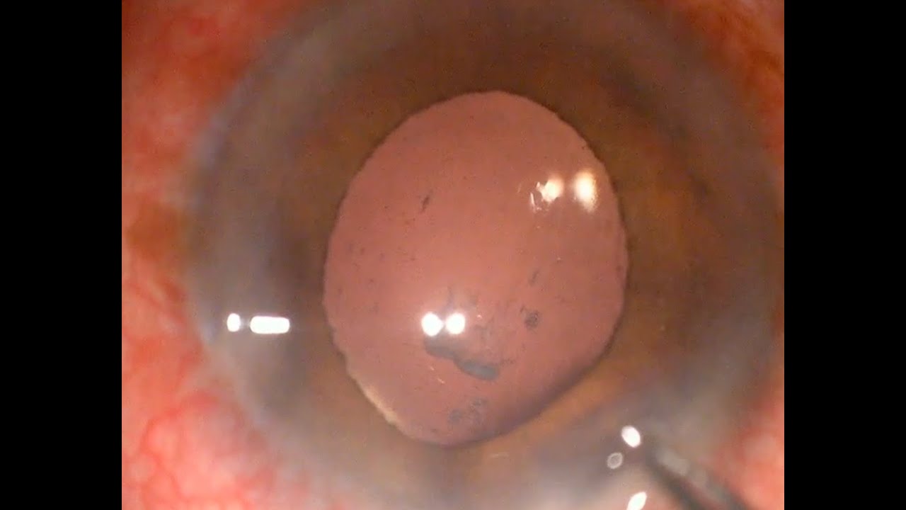 Posterior Capsular Plaque Removal after Cataract removal in a Silicone ...