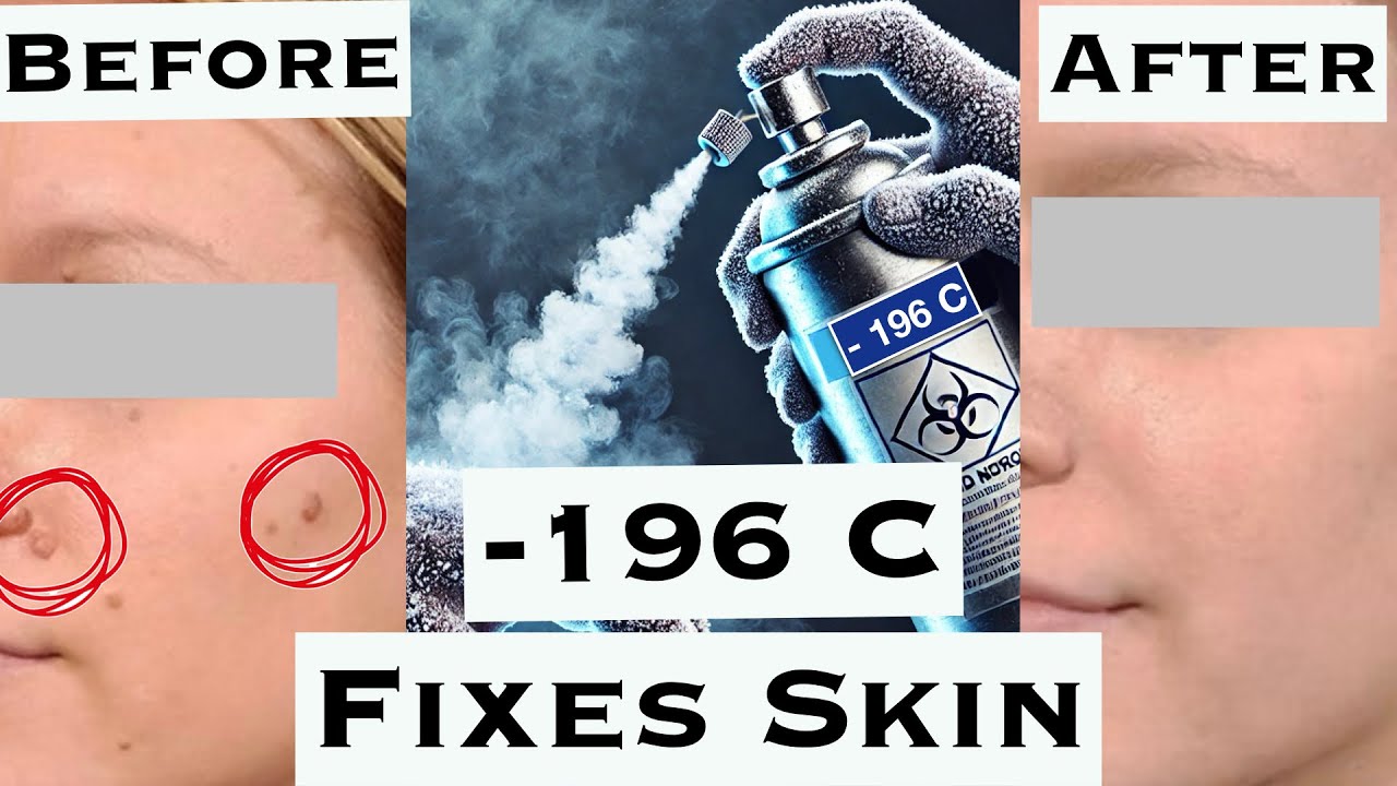 Cold Blasting Skin Tags Fast | Dermatologist #cyst #skintags # ...