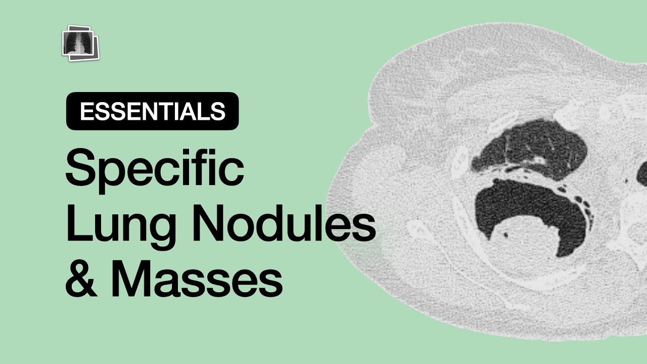 Specific Lung Nodules & Masses | Chest Radiology Essentials - YouTube