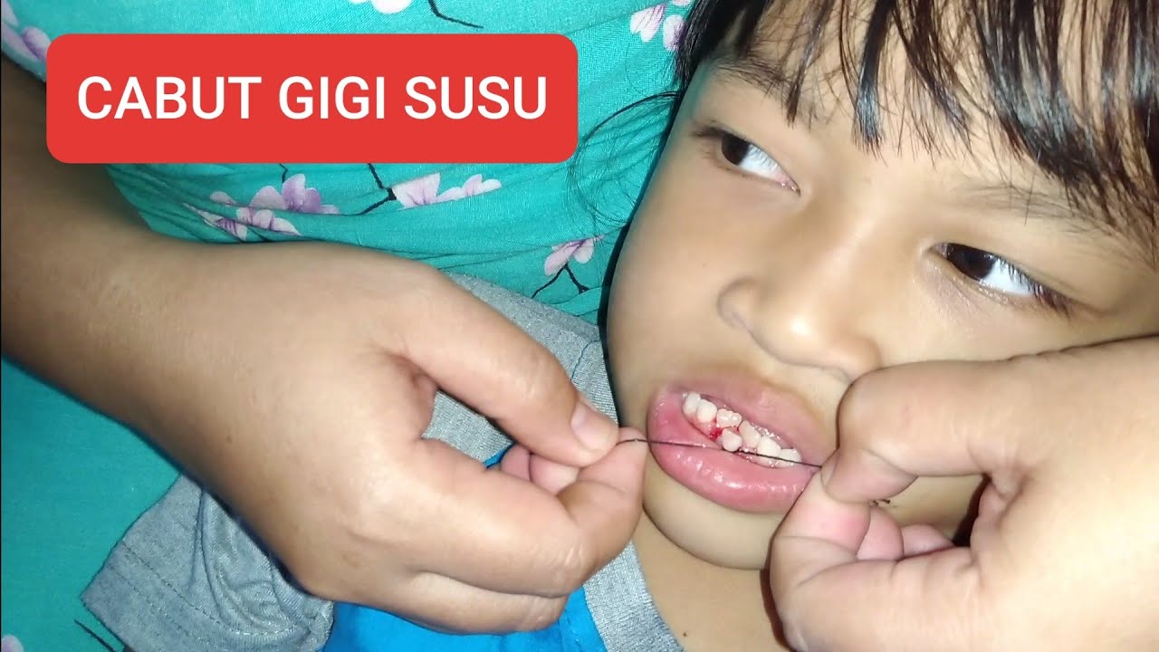 Cara Mudah Cabut Gigi Susu - YouTube