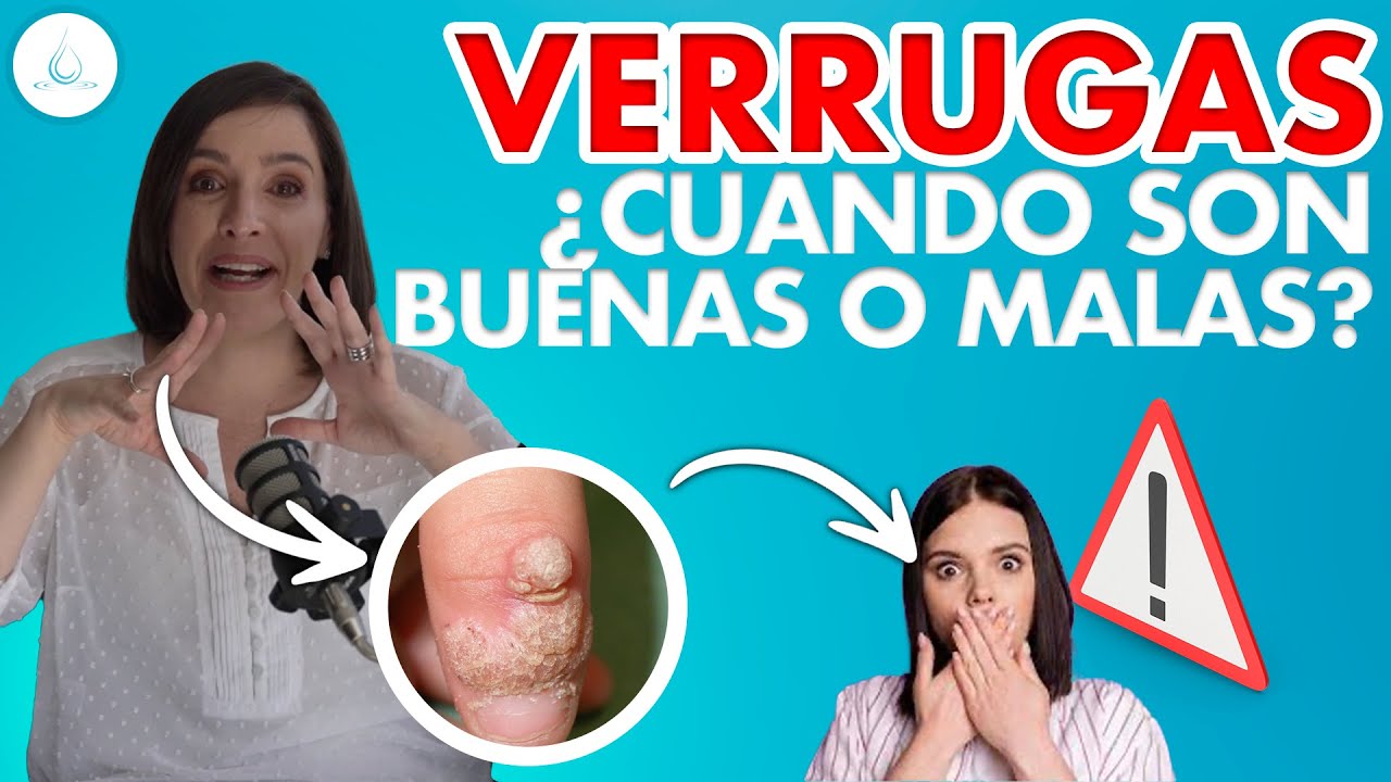 🔴 VERRUGAS ¿Que son, por que aparecen y como se tratan? @drapilarochoa ...