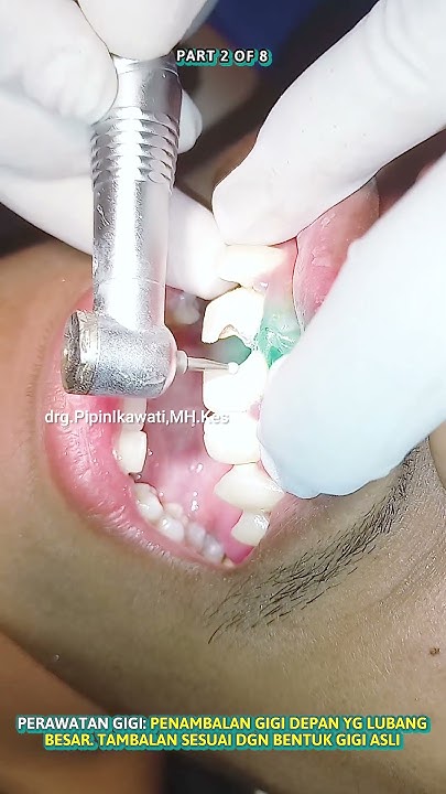 PENAMBALAN GIGI DEPAN YANG LUBANG BESAR. TAMBALAN SESUAI DENGAN BENTUK GIGI ASLI || PART 2 OF 8 ...
