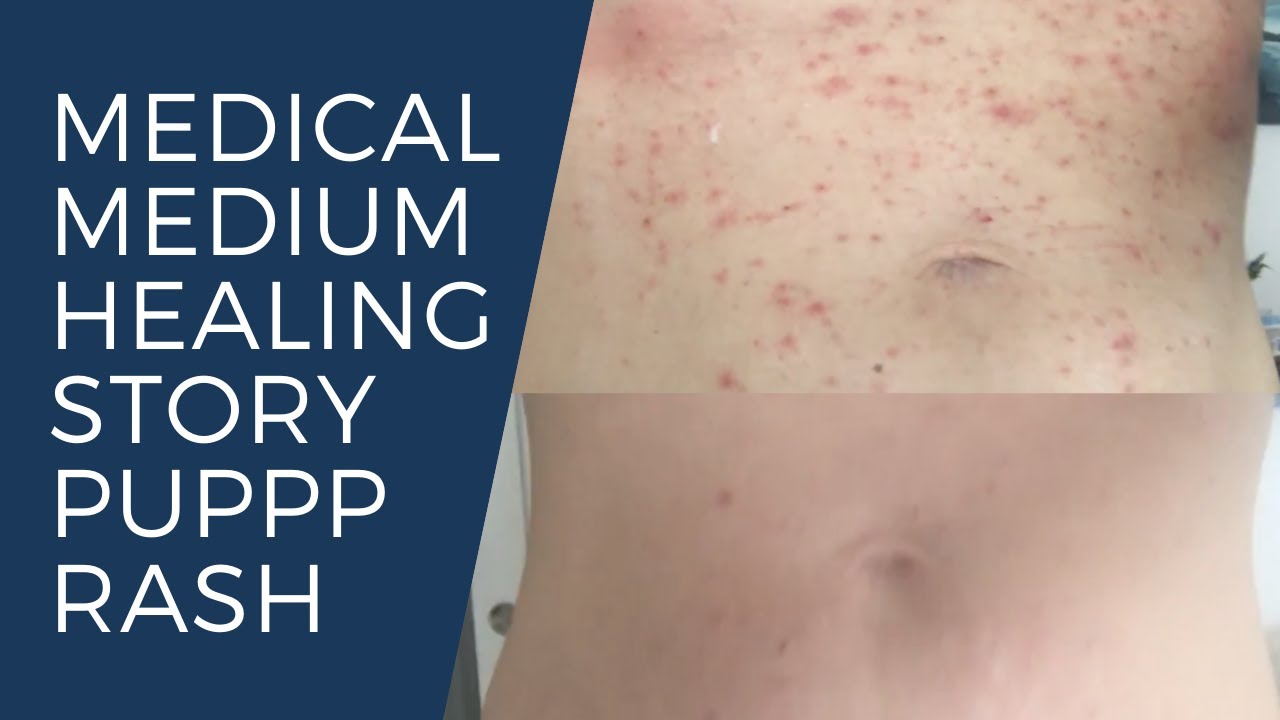 Medical Medium Healing Story Testimonial How To Heal PUPPP Pregnancy medical-medium-healing-story-testimonial-how-to-heal-puppp-pregnancy