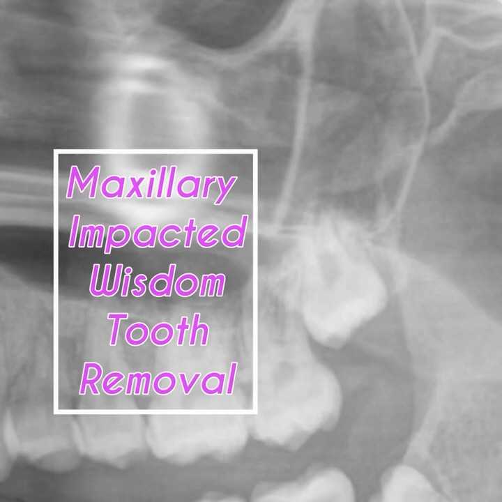 Impacted Upper Wisdom Tooth Extraction Video - YouTube
