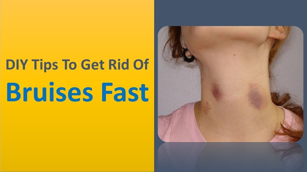 DIY tips to get rid of bruises fast - easy tricsk to remove bruises ...