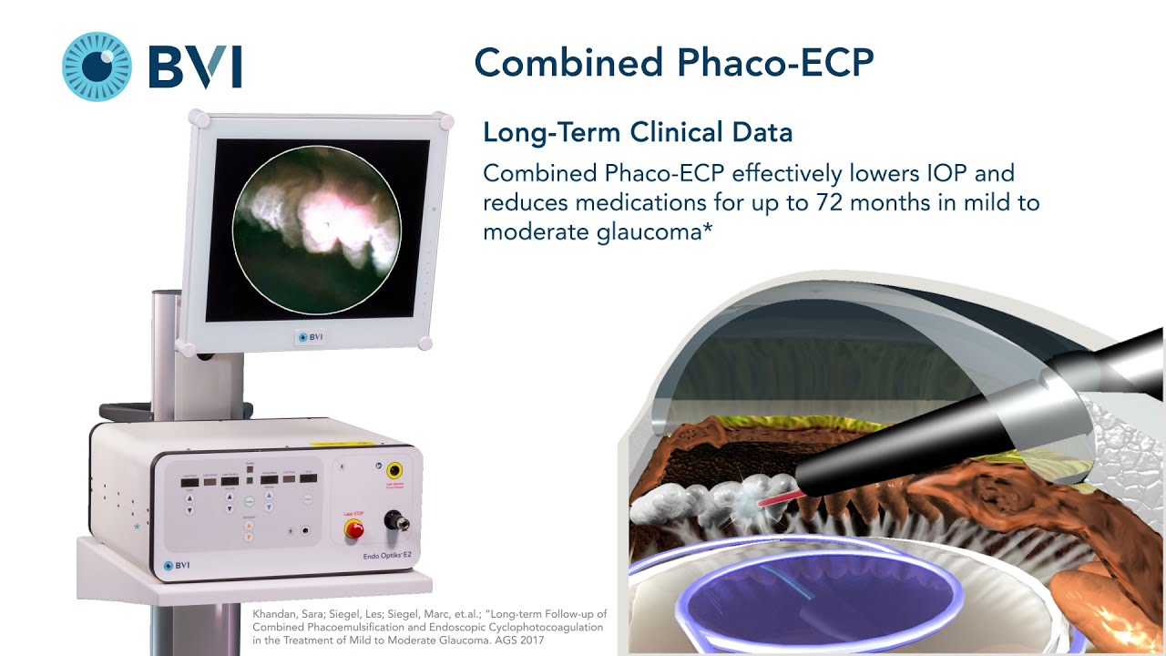Basics of ECP performed with Phacoemulsification - YouTube