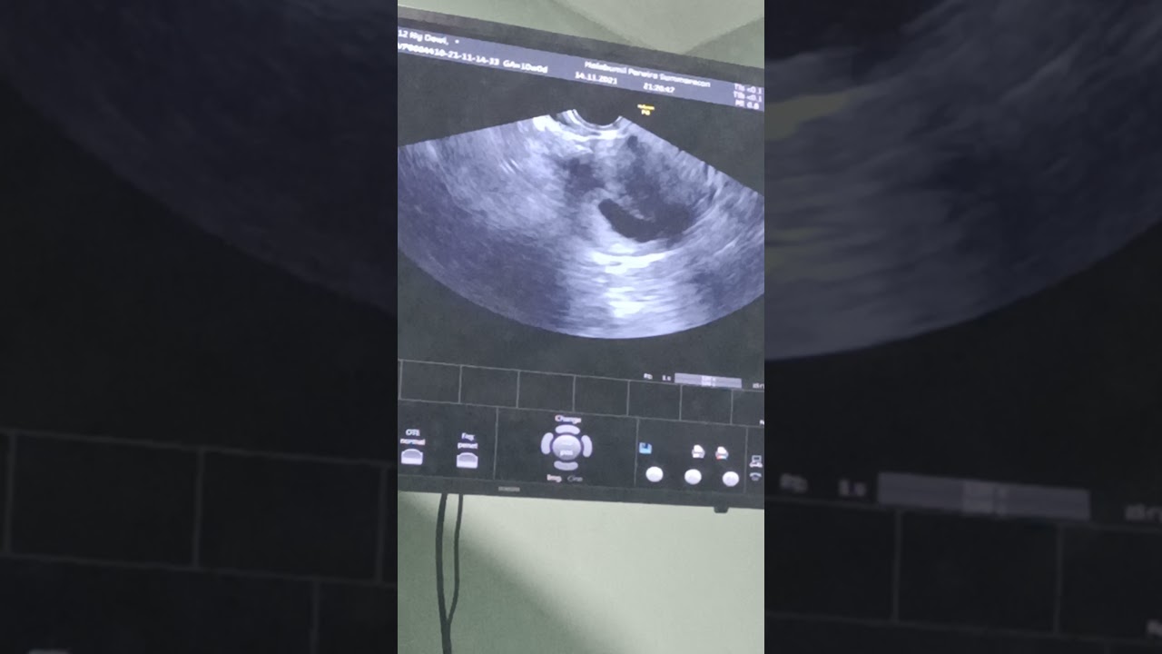 Hasil USG 8 minggu - YouTube