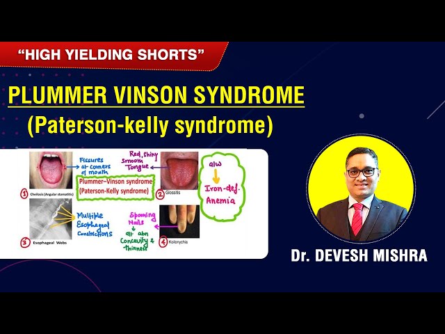 Plummer Vinson Syndrome Mnemonic