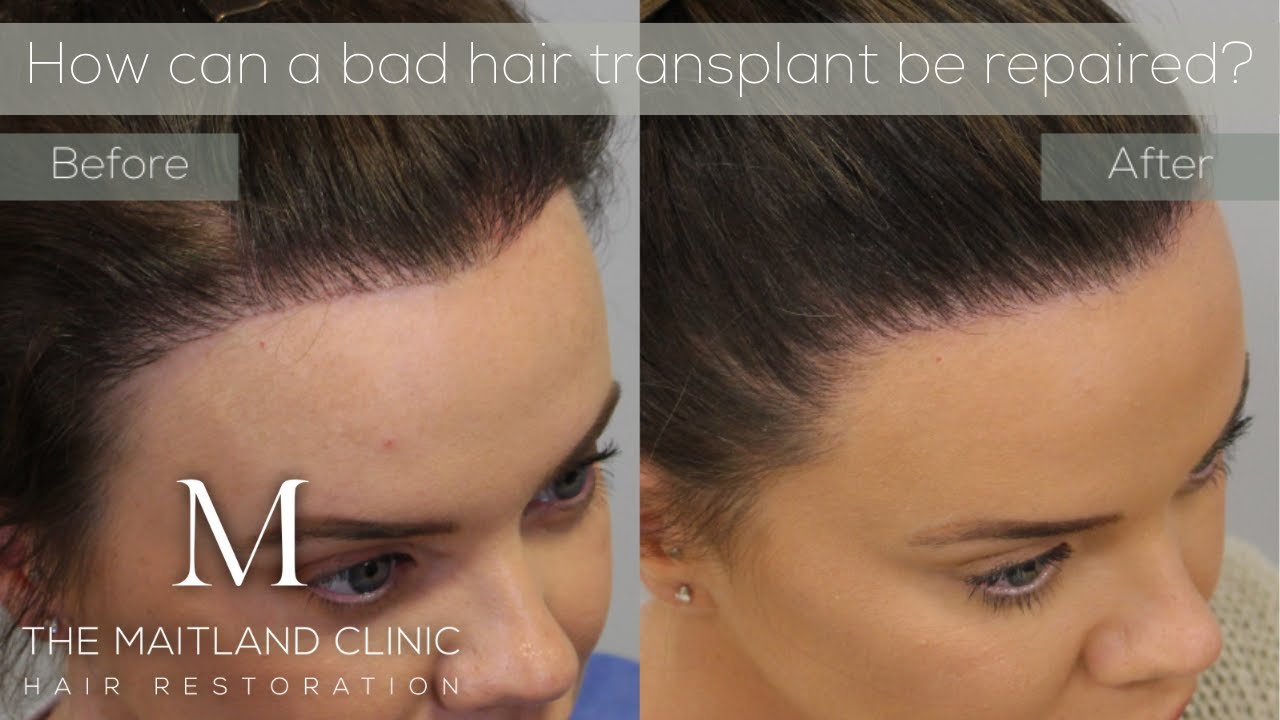 How can a bad hair transplant be repaired? FAQs answered by Dr. Edward ...