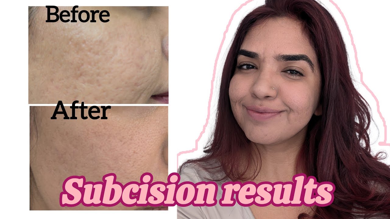 Before & After: Acne scar results after 2 subcision treatments - YouTube