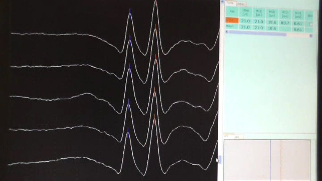 #Neuromuscular #junction tests (#Repetitive #Nerve #Stimulation and # ...