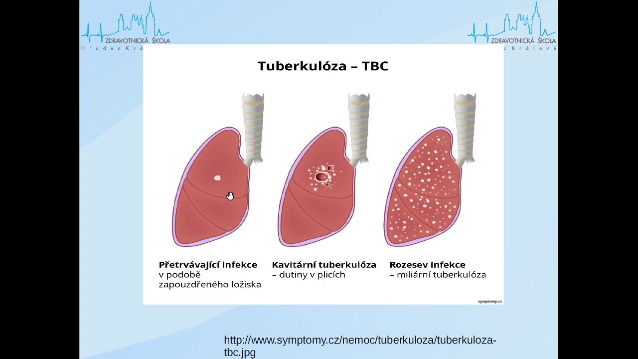 Tuberkulóza - YouTube