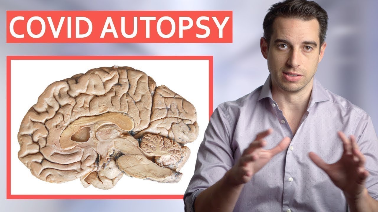18 COVID Autopsies - This is what they found in the Brain 😱 - YouTube