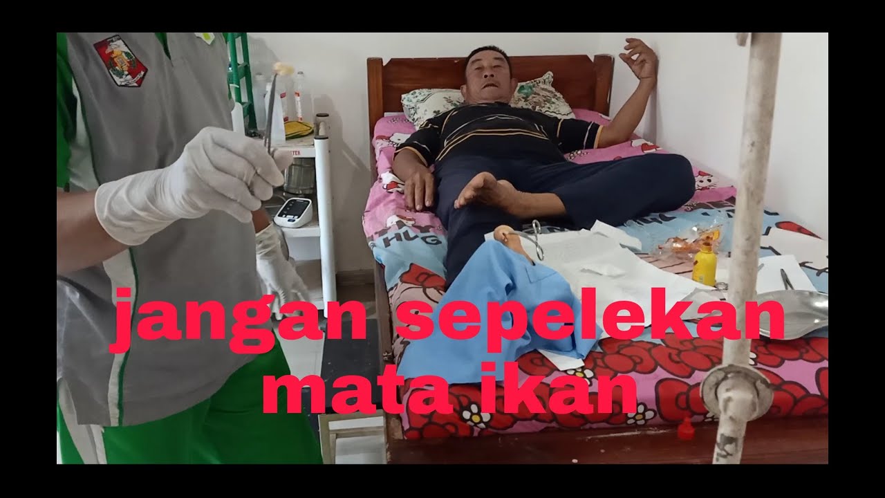 Cara menghilangkan mata ikan sampai akar tanpa rasa sakit#mataikan#kutil# - YouTube