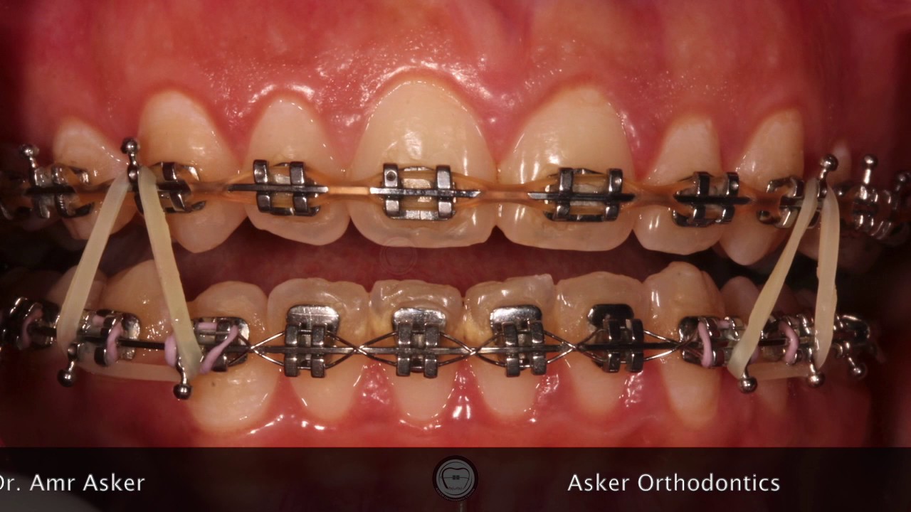deep bite in orthodontics, orthodontic courses and education by asker orthodontics Dr. Amr Asker ...