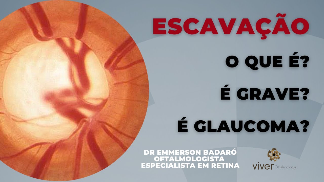 Actualizar 48 Imagem Nervo Optico Fundo De Olho Vn