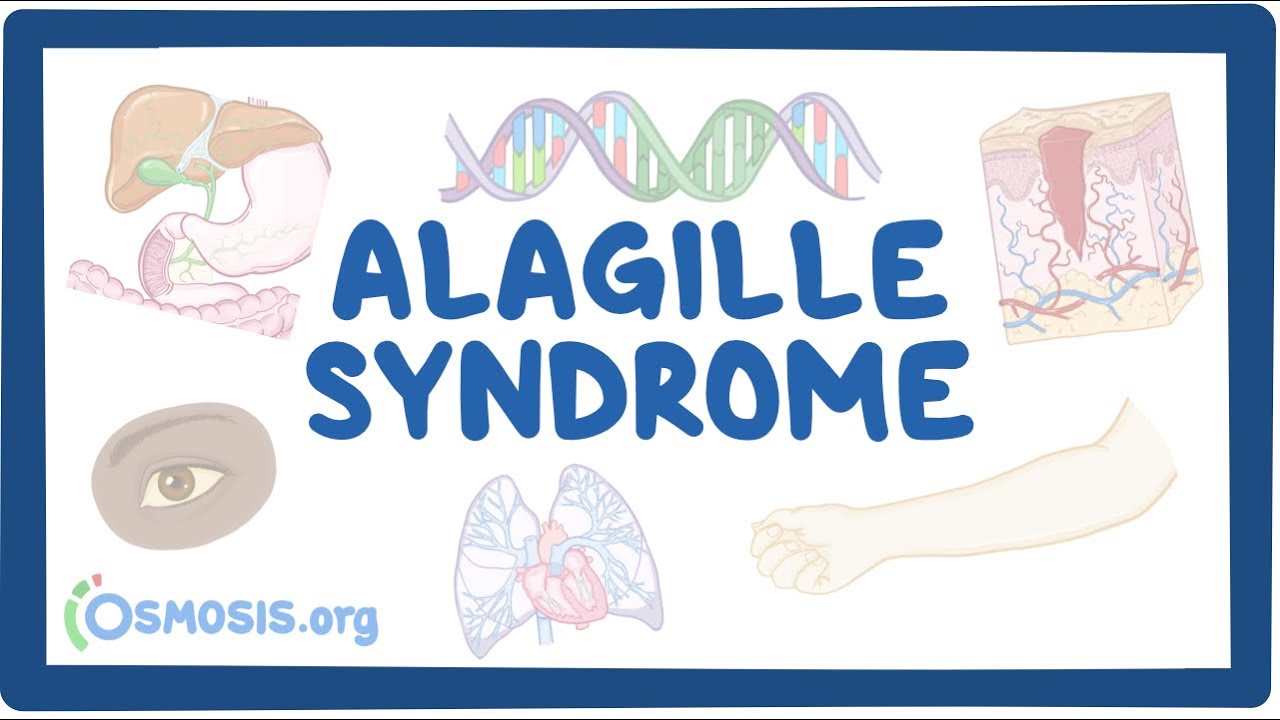 Alagille Syndrome- causes, symptoms, diagnosis, treatment, pathology ...