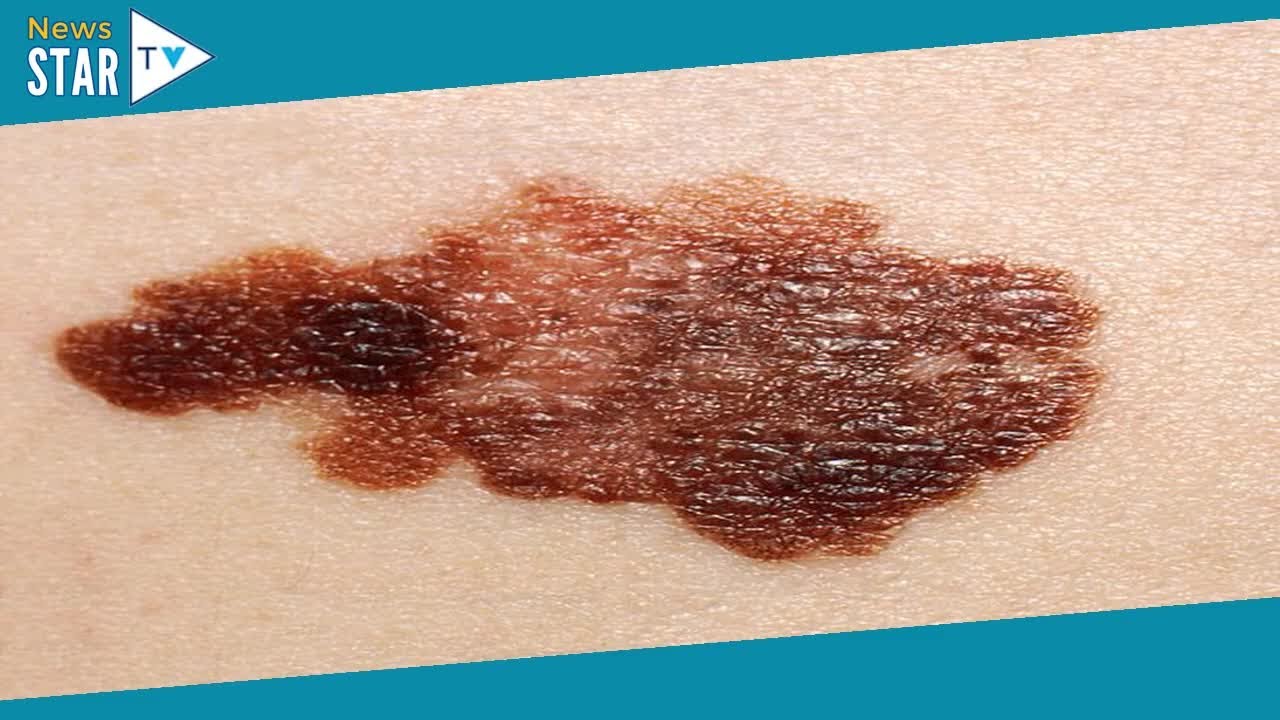 Skin cancer expert names red flag area on the body for melanoma to ...