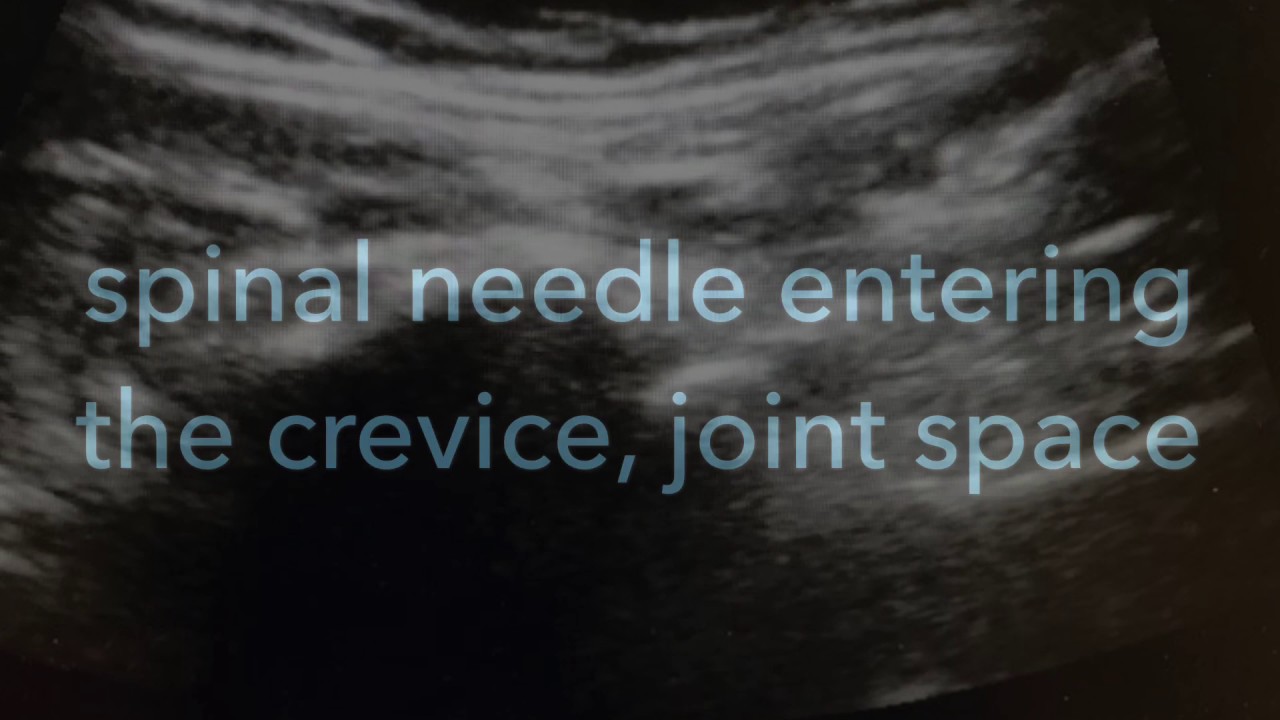Si Joint Ultrasound Injection at Sam Kyle blog