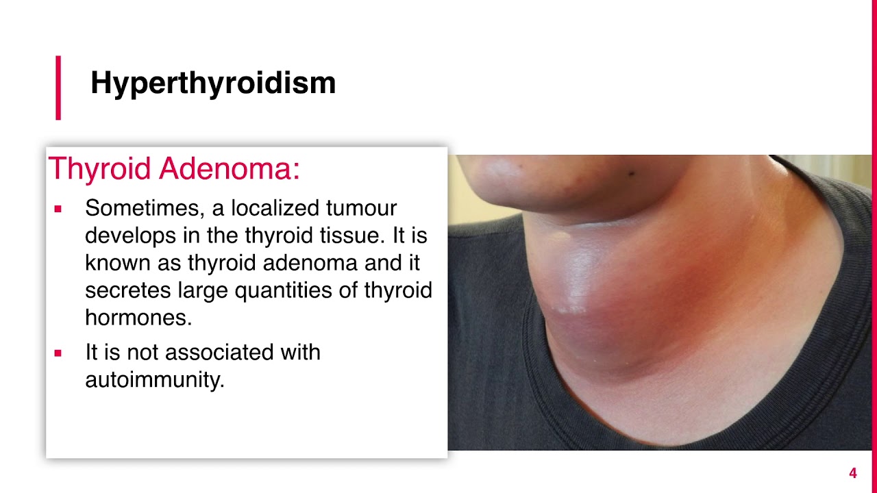 What is Hyperthyroidism | Physiology | General Medicine - YouTube