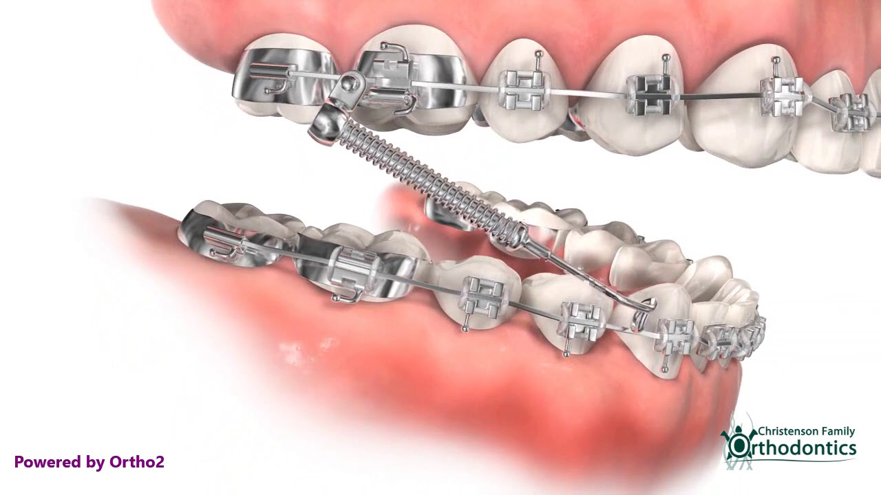 Orthodontic Forsus Springs - YouTube