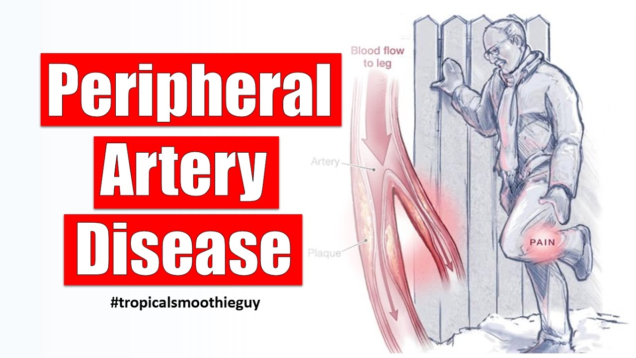 How Peripheral Artery Disease Affects Your Circulation - YouTube