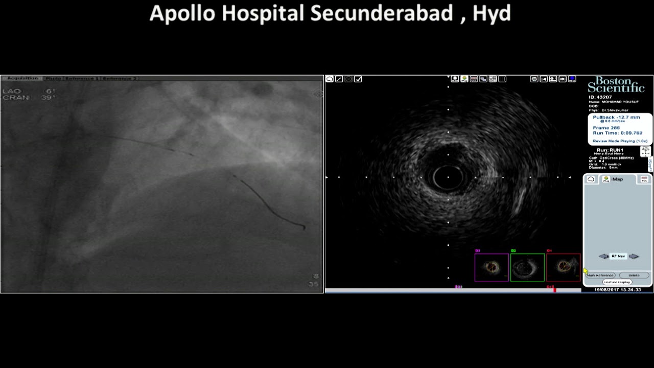 ACVS India 2017 Dr.Shivkumar Jallepalli, Apollo, Secunderabad - YouTube