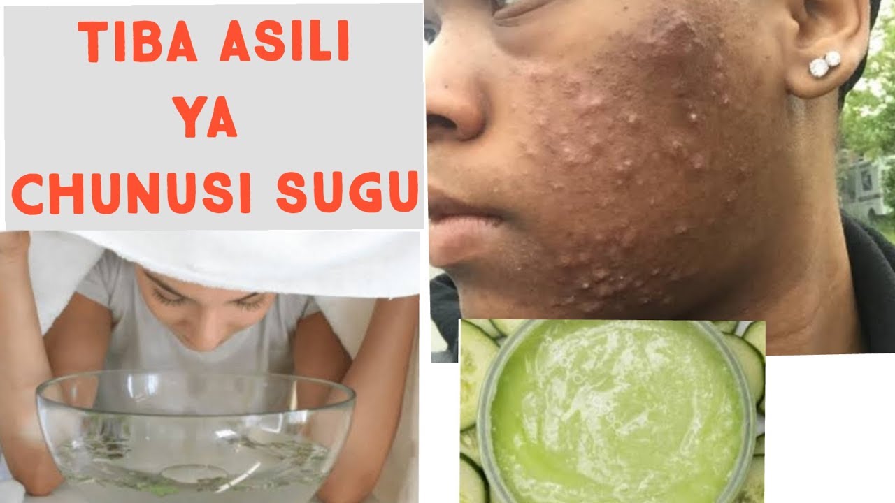 Tiba ya chunusi sugu kwa wiki 3 tu - YouTube