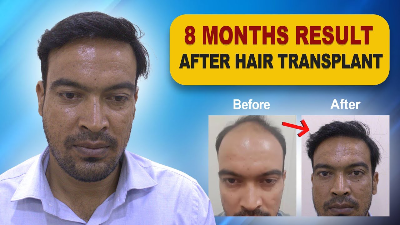 8-Month Results Revealed! | Hair Transplant Journey | 8-Month Hair ...
