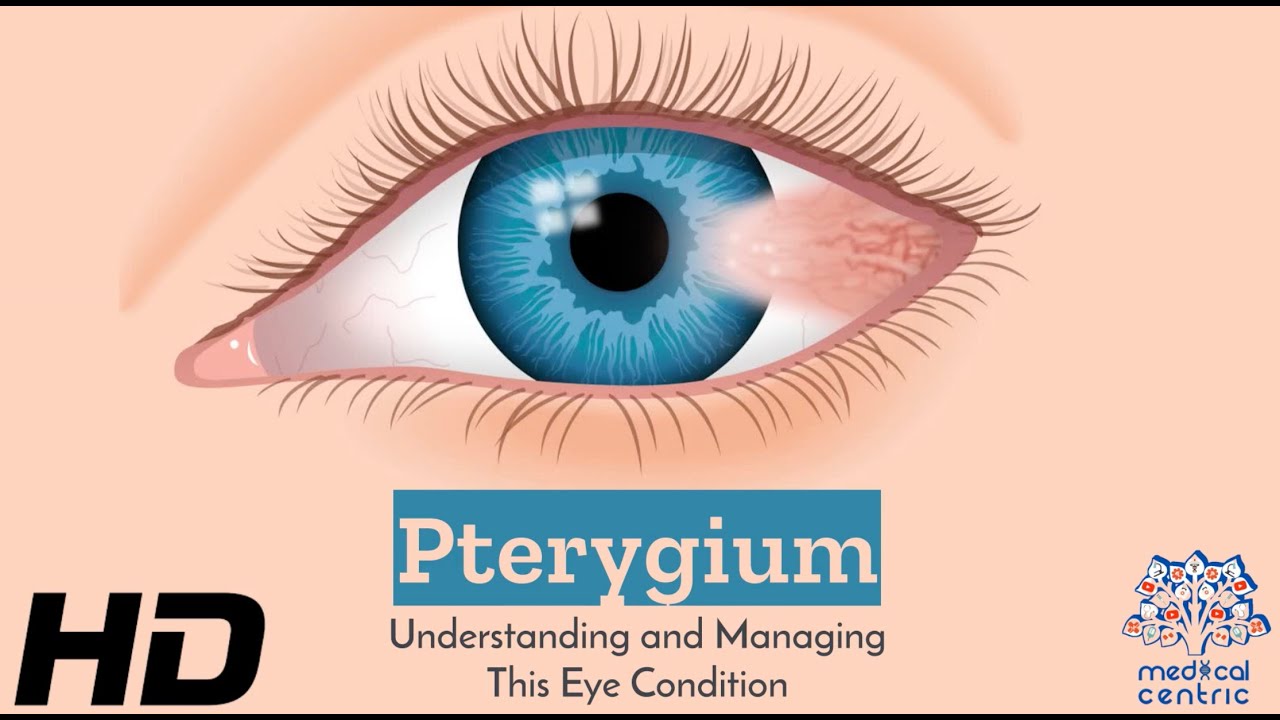 Eyes on Pterygium: How to Protect and Preserve Your Vision - YouTube