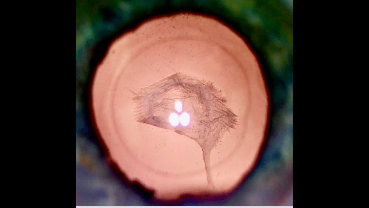 To Yag or not to Yag? The Posterior Capsular Plaque. Shannon Wong, MD ...