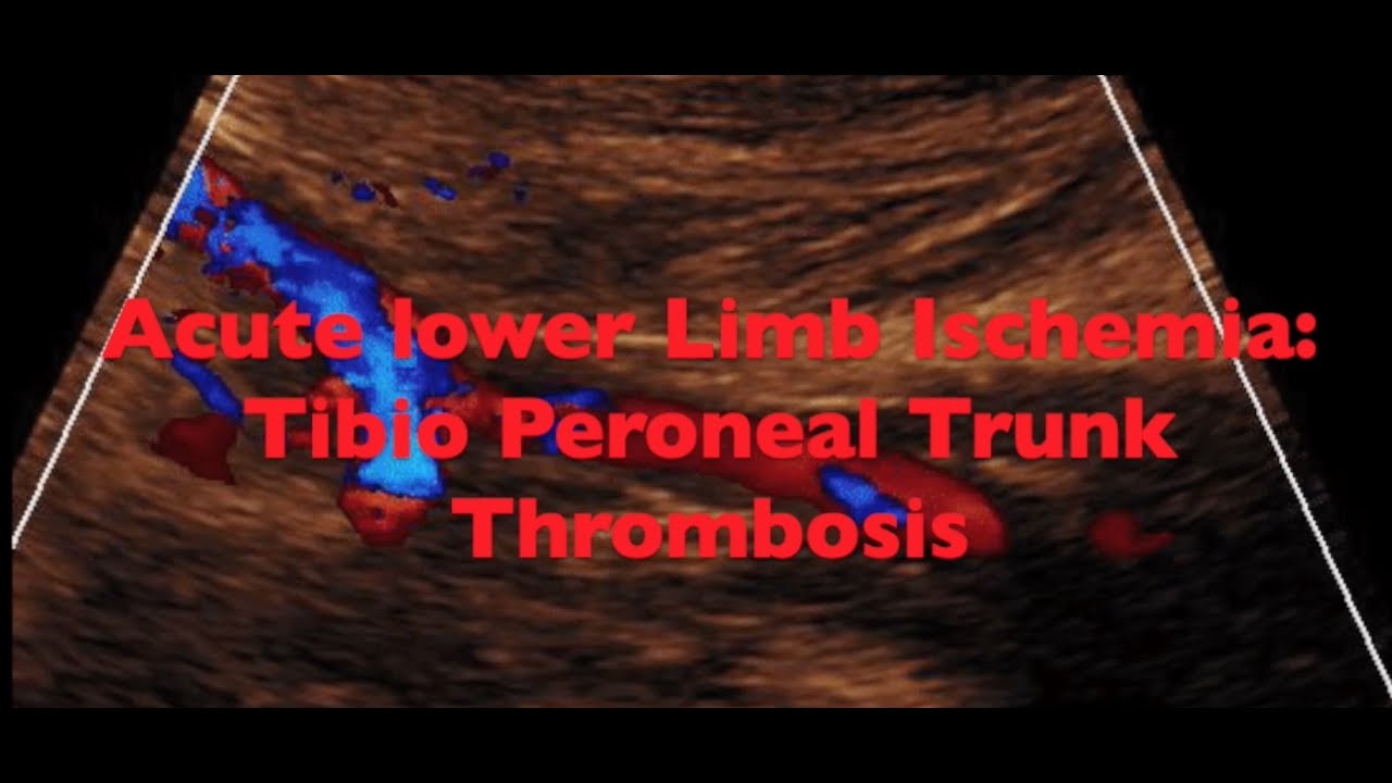 Acute Lower Limb Ischemia: Tibio Peroneal Trunk Thrombosis - YouTube