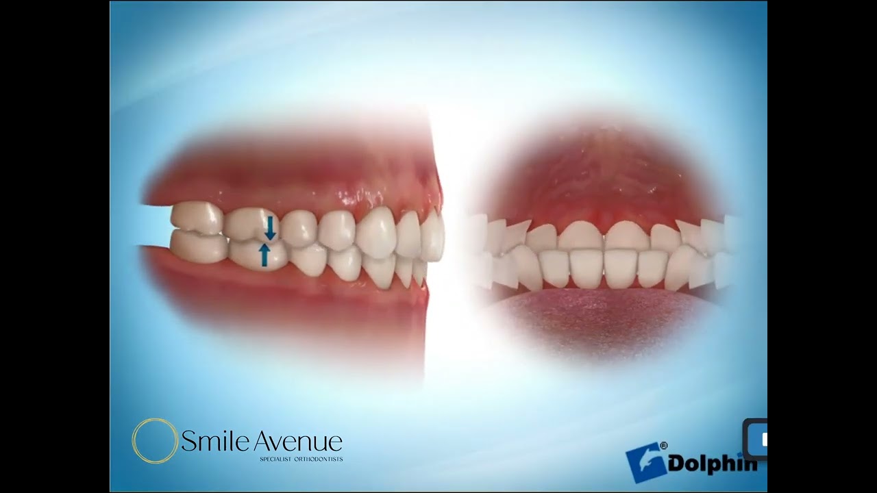 Deep Bite Invisalign