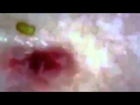 Zit Popping Extreme! Blackheads and Whiteheads - YouTube