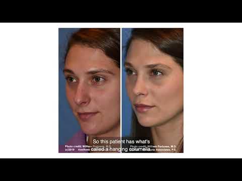 Lifting a Hanging Columella - Rhinoplasty - YouTube