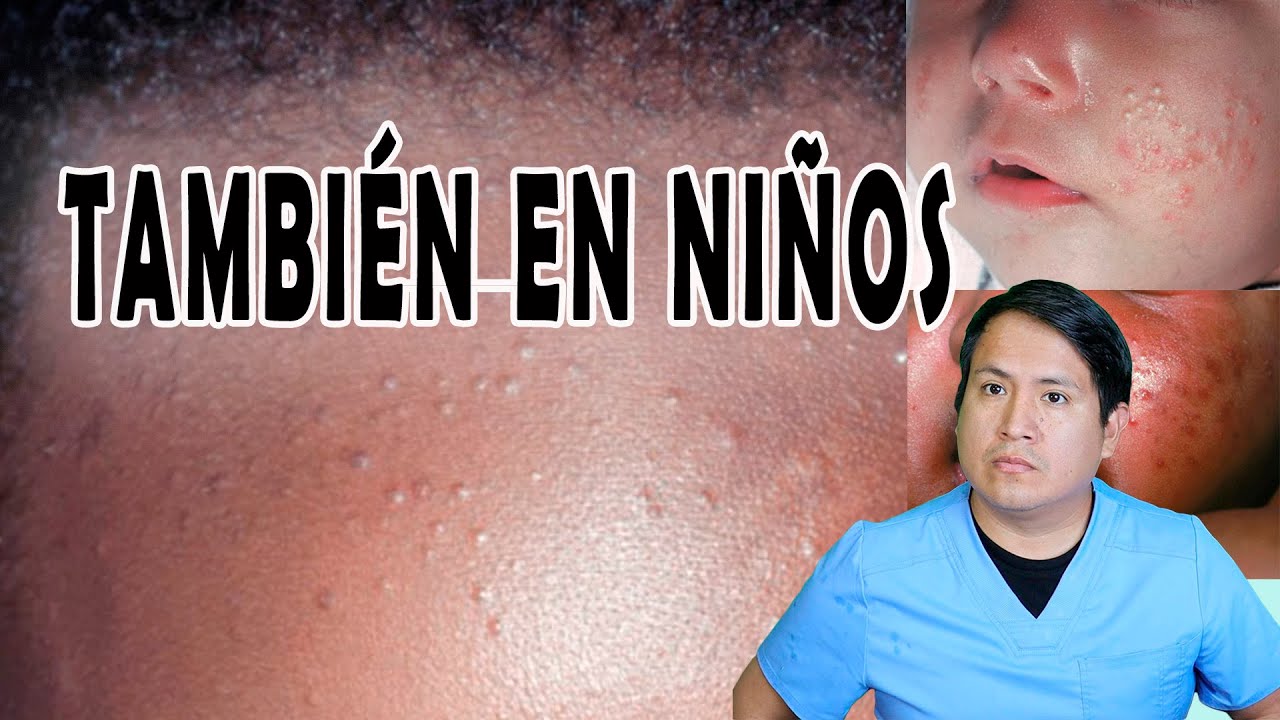 CÓMO ELIMINAR EL ACNÉ EN NIÑOS - YouTube
