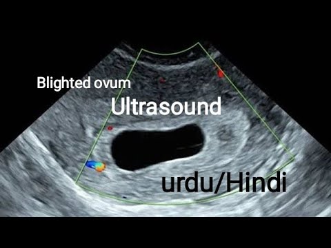 Blighted Ovum/Anembryonic Pregnancy on ultrasound - YouTube