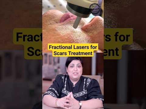 Laser Treatments for Face | Pimples and #Acne #Scar Laser Treatments #laser #resurfacing #shorts