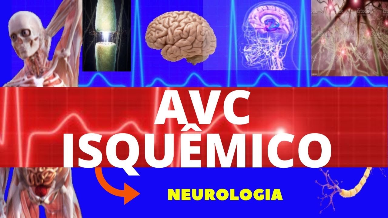 ACIDENTE VASCULAR CEREBRAL ISQUÊMICO (CAUSAS, SINTOMAS, DIAGNÓSTICO E ...