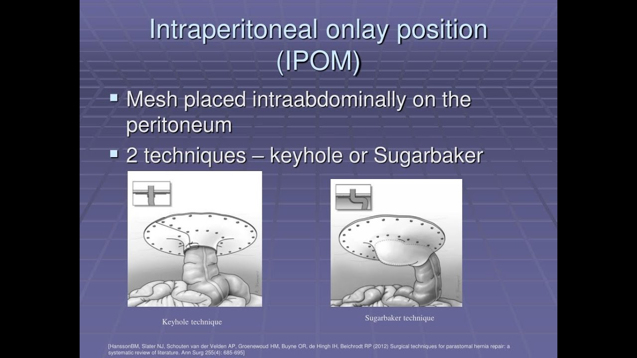 Laparoscopic parastomal hernia repair - YouTube