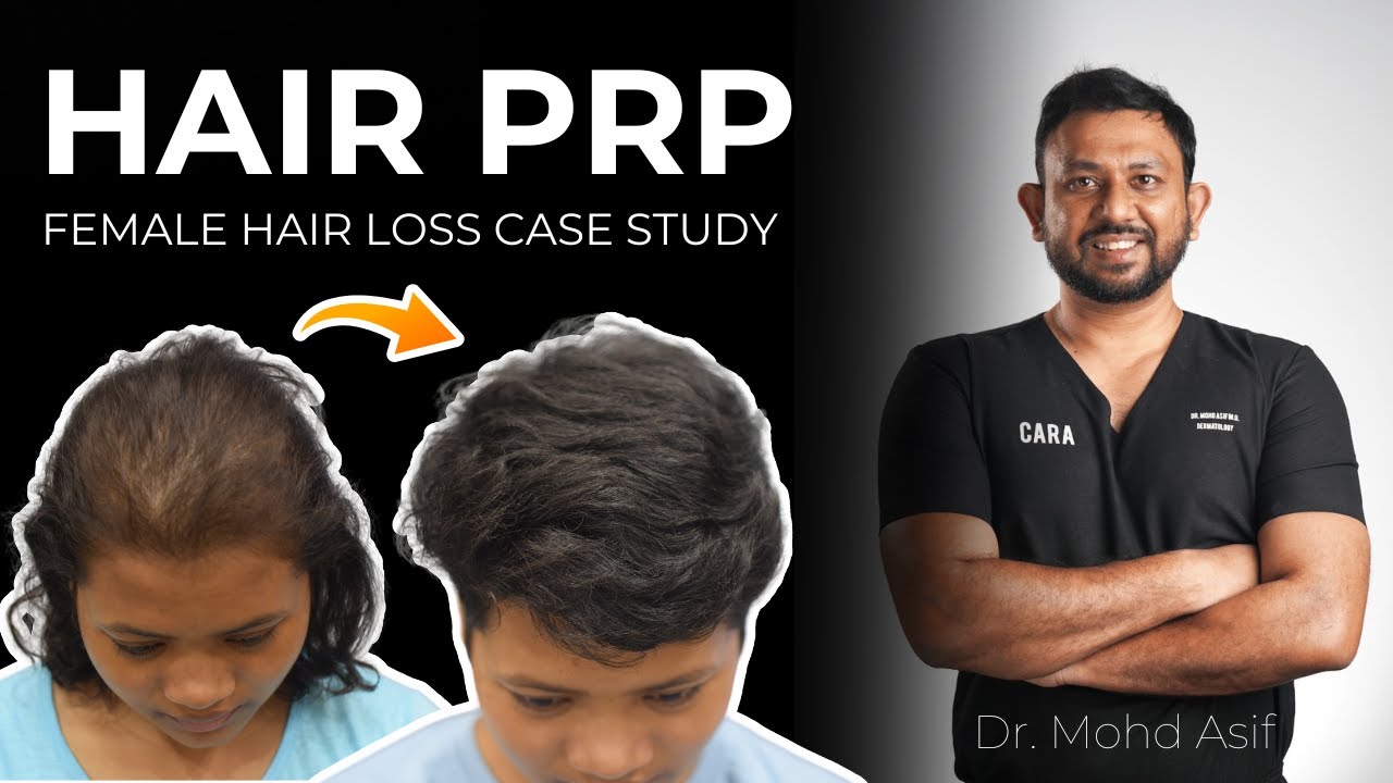 Hair PRP: Too Good To Be True ? Female Hair Loss Case Study By Dr. Asif #prptreatment - YouTube