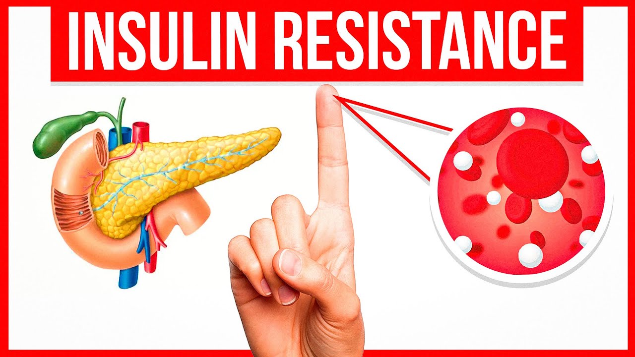 How To Fix Insulin Resistance | How To Improve Insulin Resistance – GFSOX