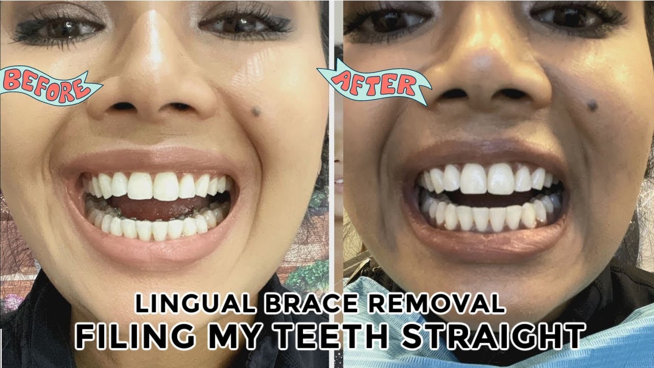 Filing round/chipped teeth straight (enameloplasty) & inbrace lingual ...