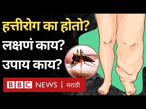 हत्तीरोग लक्षणं, कारणं, उपाय : Lymphatic filariasis (Elephantiasis ...