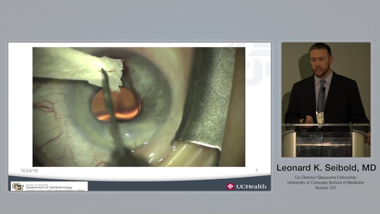 LEONARD SEIBOLD, MD - Results with the Kahook Dual Blade (KDB)- EYE ...