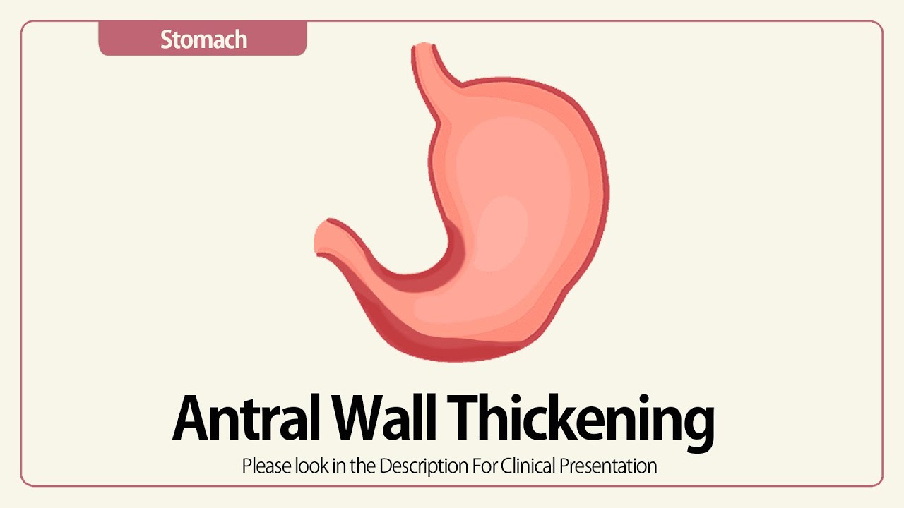Malignant Antral Wall Thickening - YouTube