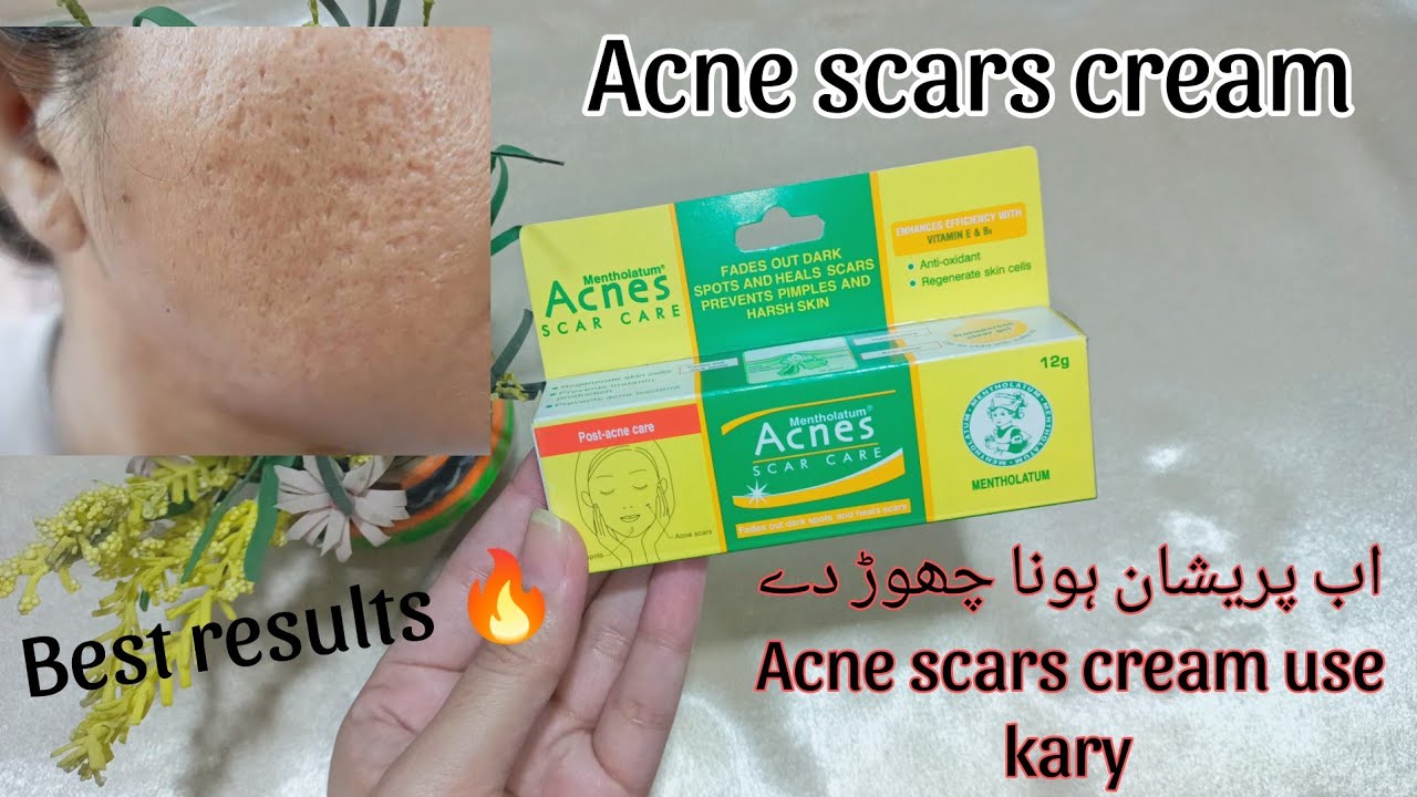 Acne Scars Cream Review Acne Marks Removal Cream Acne Acnescars