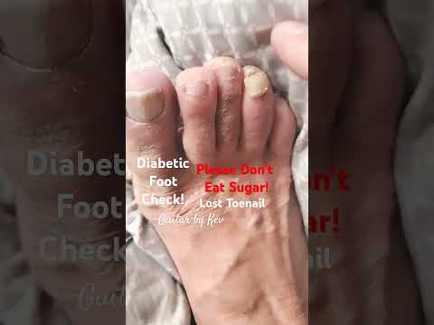 Diabetic Foot Check Toe Nail Warning Dry Skin Wounds Sugar Results ...